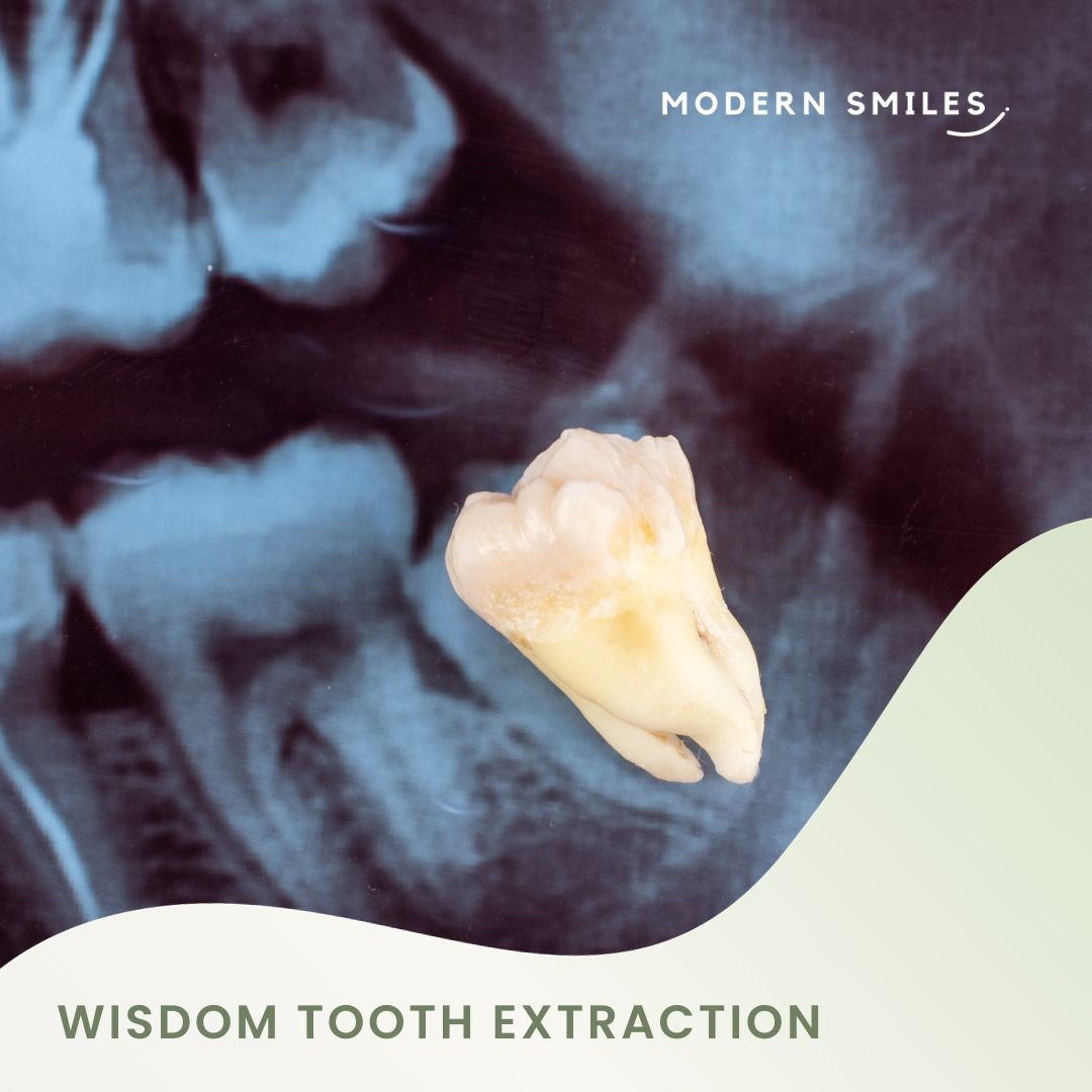 Tooth Extraction – Modern Smiles