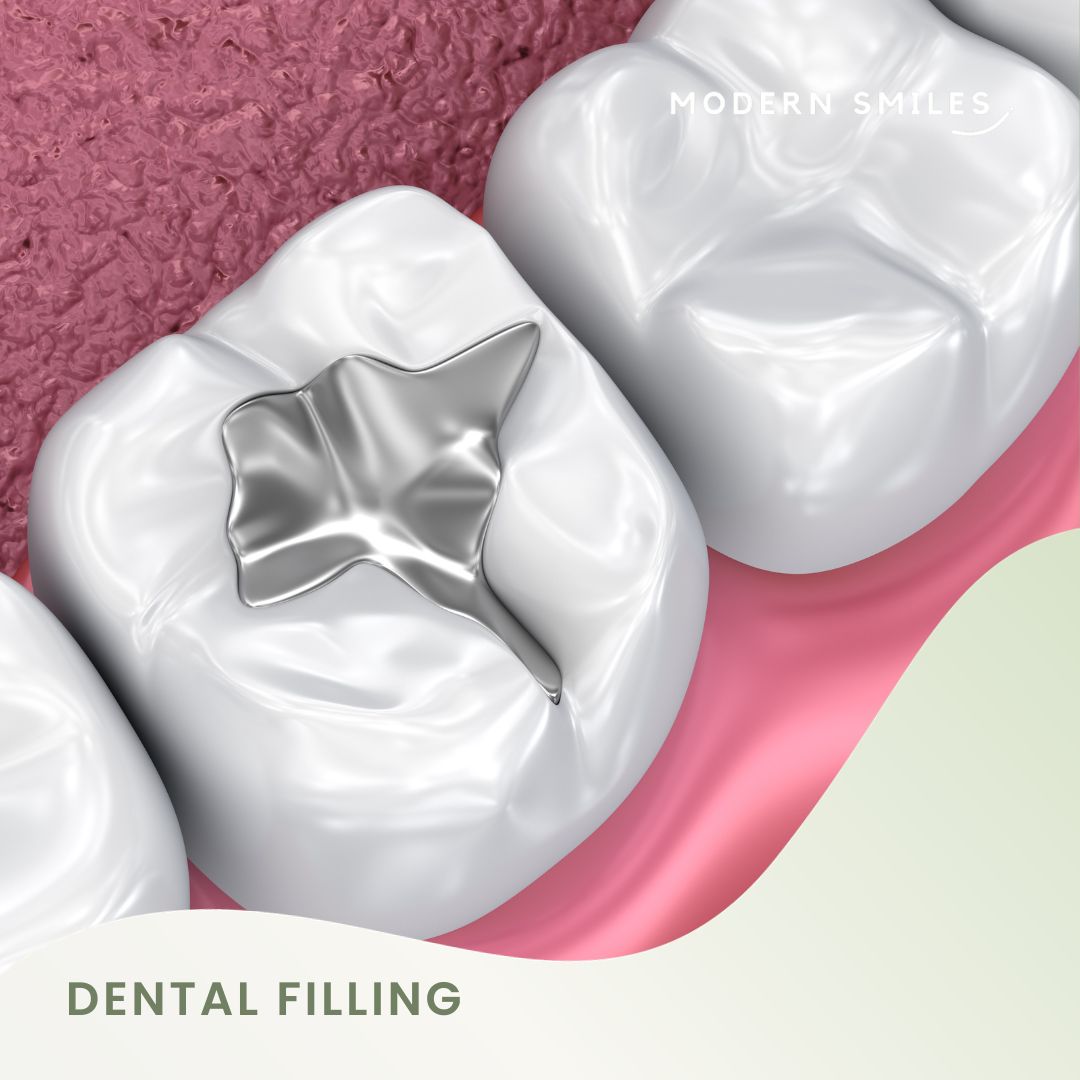 Dental Filling (Light Cure) – Modern Smiles